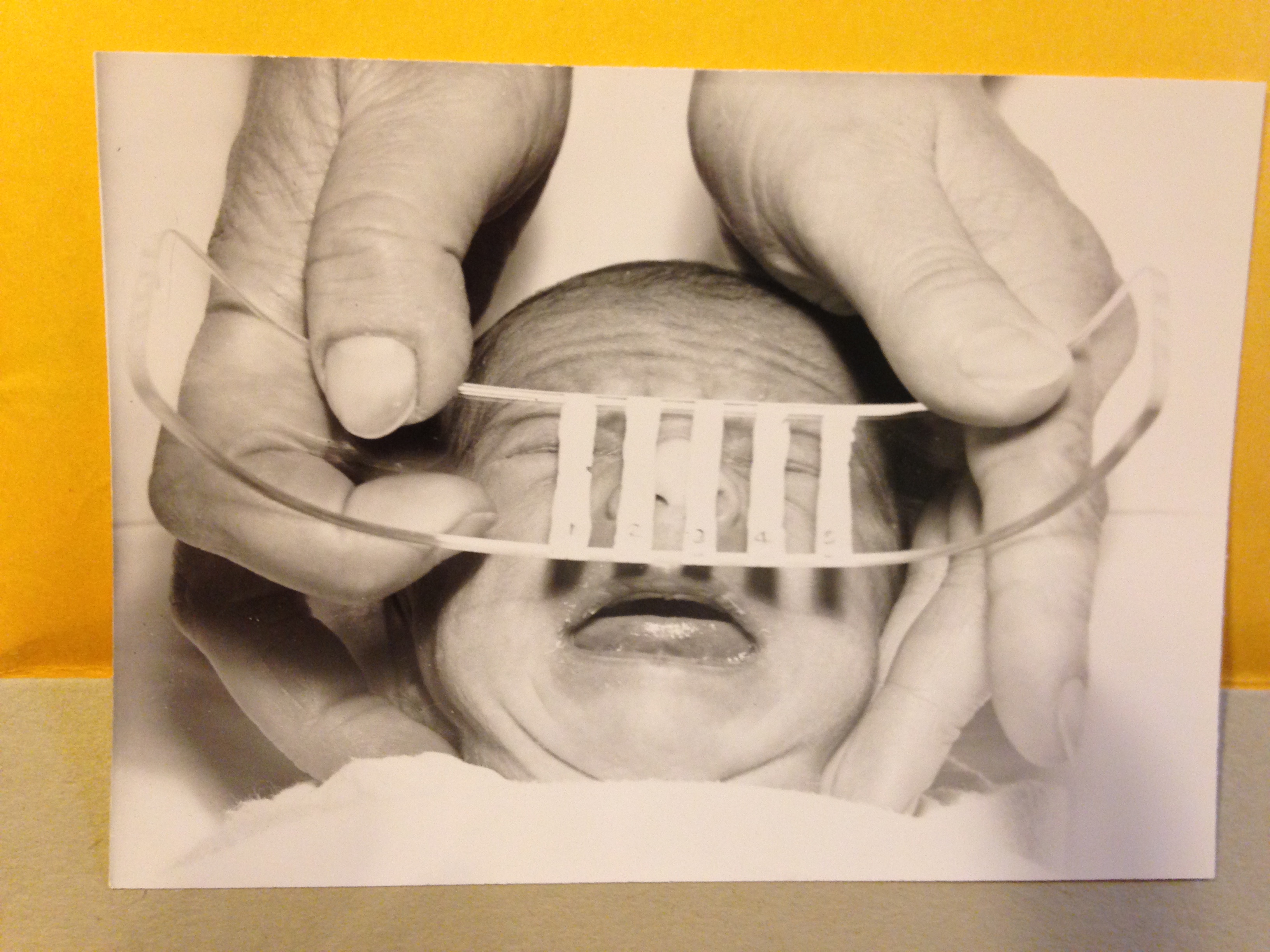 The 'Gosset' Icterometer